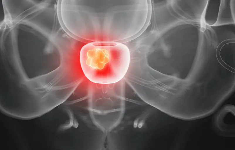 ¿Cómo saber si la próstata está inflamada? | Dra. Karelia Franceschi ...